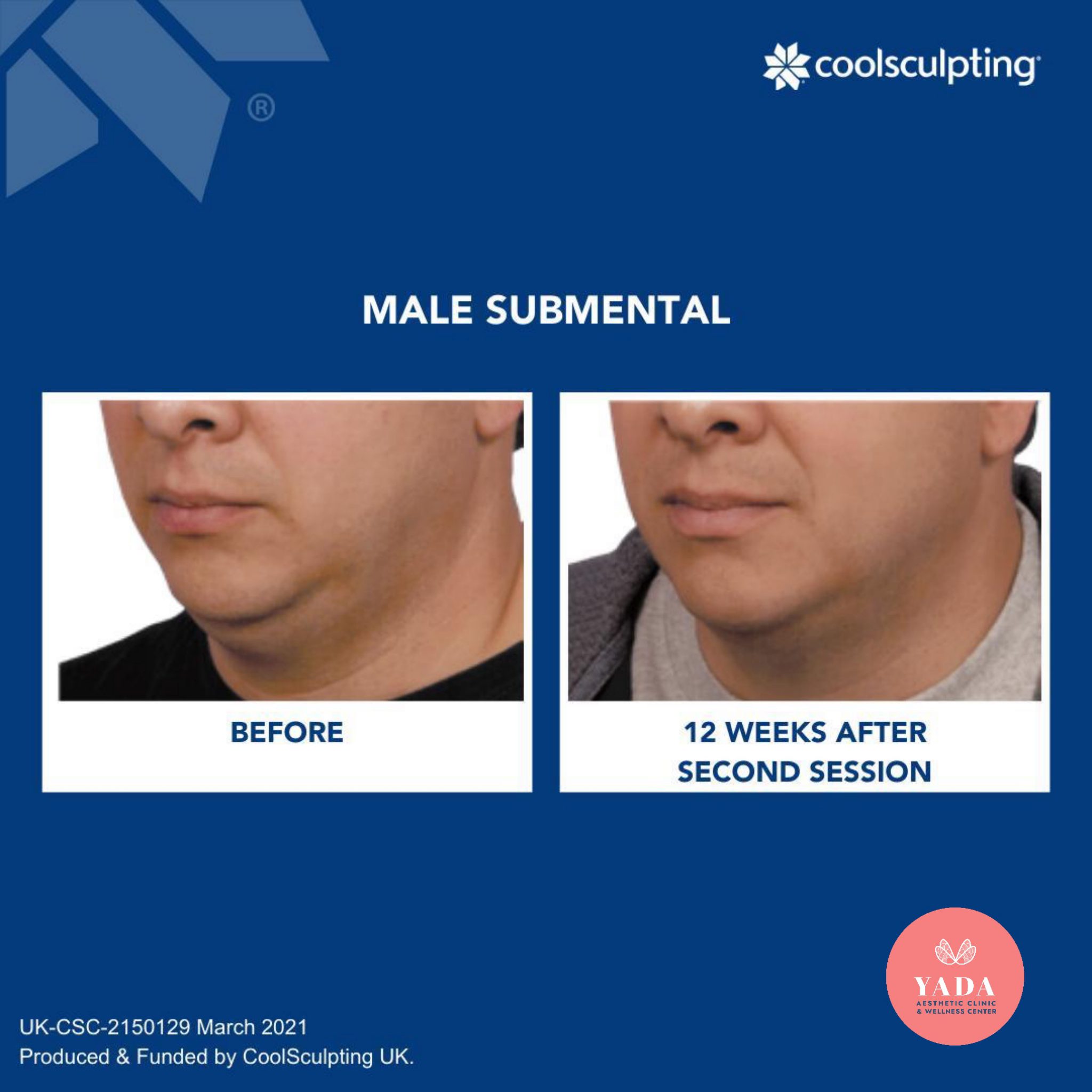 coolsculpting submental fat yada clinic pattaya | Doctor Yada Clinic ...